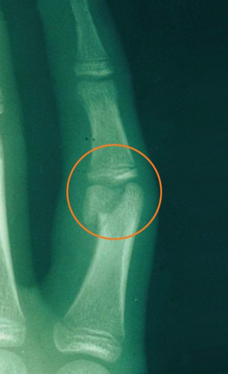 Fractures in Children: Causes, Symptoms, & Treatment - Orthopedic ...