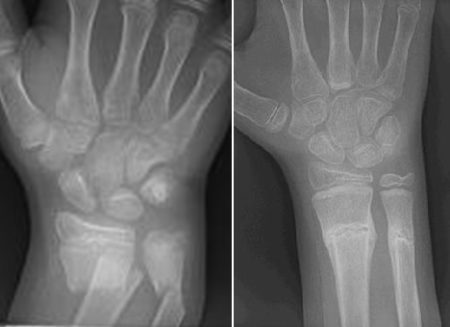 Broken Arm: Signs, Symptoms, & Treatments - Orthopedic & Sports Medicine
