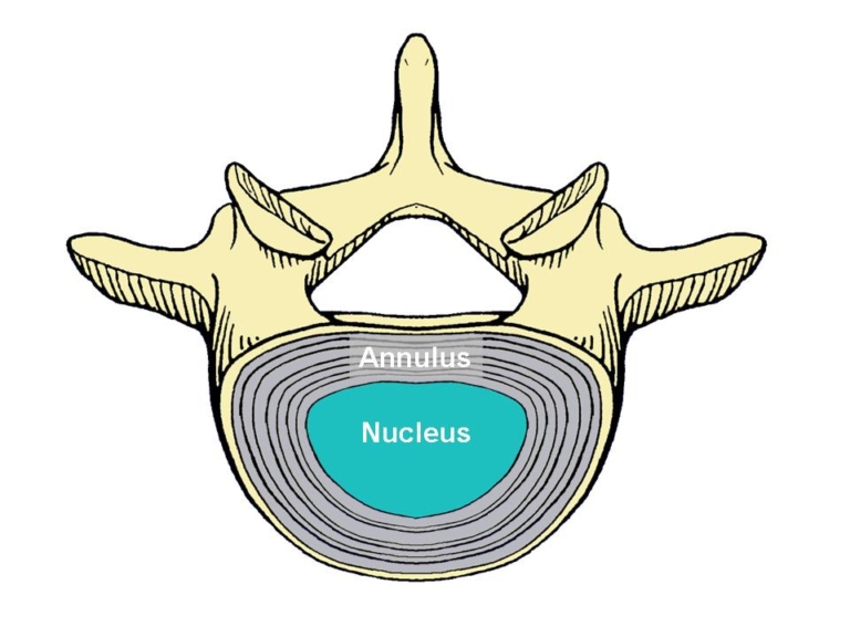 Artificial Disk Replacement - Orthopedic & Sports Medicine