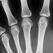 What you should know about a broken pinky toe - Orthopedic & Sports ...