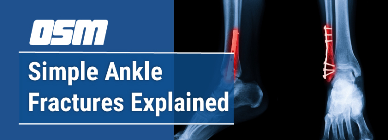 Simple Ankle Fractures Explained - Orthopedic & Sports Medicine