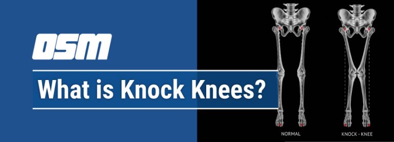 What is Knock Knees? - Orthopedic & Sports Medicine