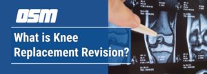 What is a Knee Replacement Revision? - Orthopedic & Sports Medicine